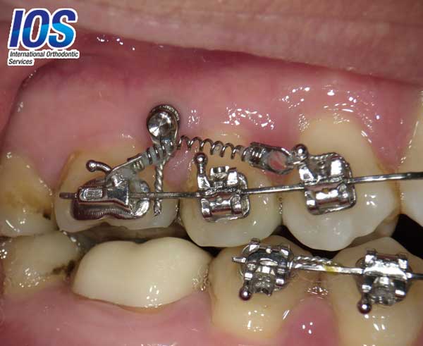 IOS Ortho. Closed Coil NiTi with Eyelets for Orthodontic Made in USA