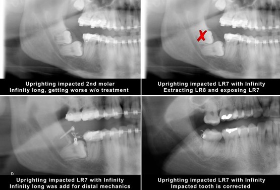 IOS Ortho. The use of Temporary Anchorage Devices TADs / Mini Implants ...