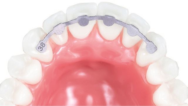 IOS Ortho. Lingual Retainers 3To 3 Kit Upper Size - Kit