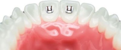 IOS Ortho. Tongue Spikes - PK/10