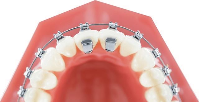 IOS Ortho. Bite Wings - PK/10