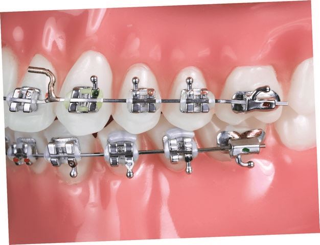 IOS Ortho. Bracket Guard Elastic - Clear - PK/100