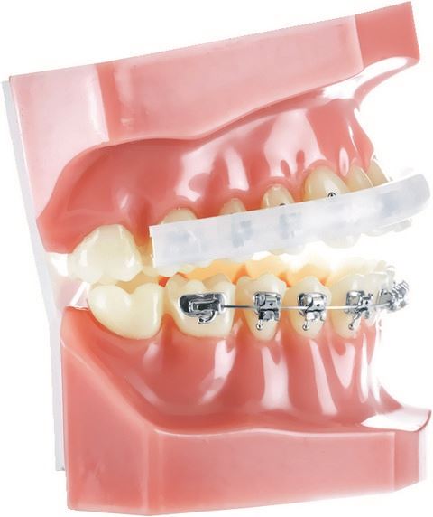 IOS Ortho. Lip Protector - Pair