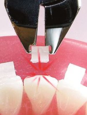 IOS Ortho. Ceramic Bracket Debonding plier - Piece