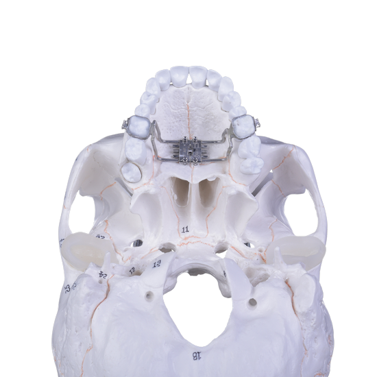 IOS Ortho. Infinity Expander 9 mm - Piece