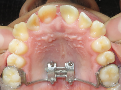 IOS Ortho. Infinity Expander 7 mm - Piece