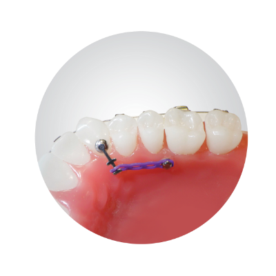 IOS Ortho. Tree Hook - PK/ 10