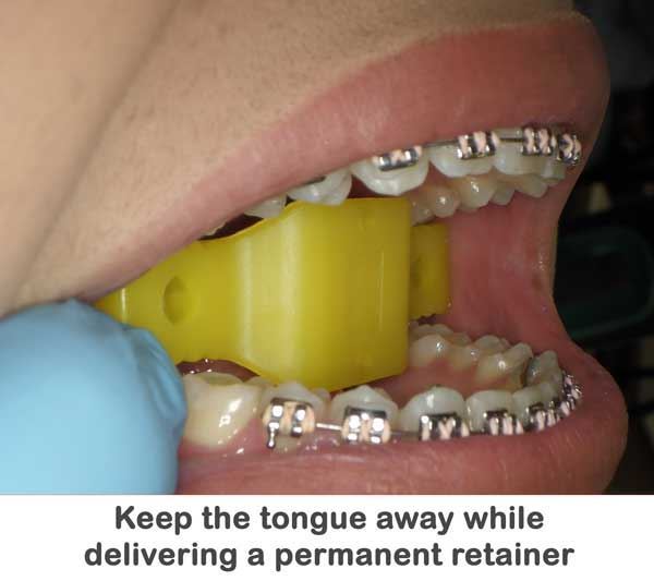 IOS Ortho. Disposable Tongue Block Small - PK/10